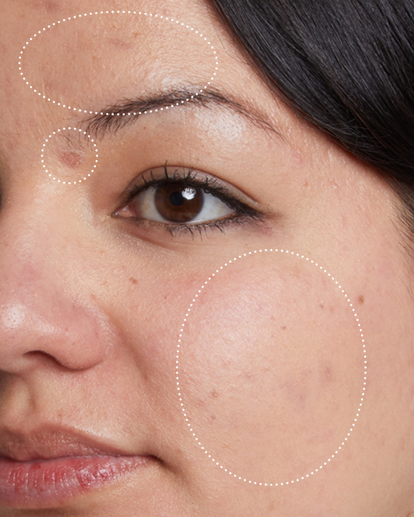 Adapinoid Gel | Skinfix – Skinfix USA