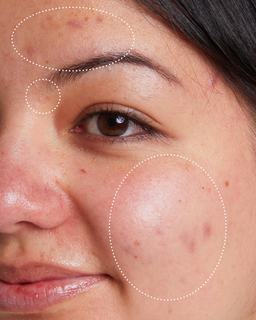 Adapinoid Gel | Skinfix – Skinfix USA