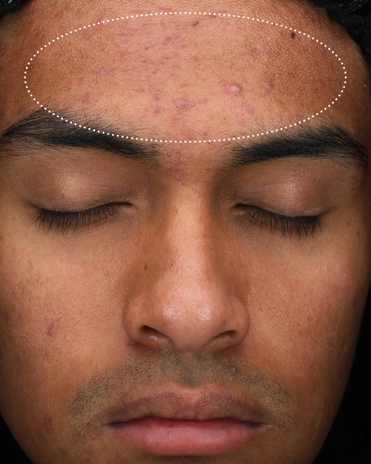 Adapinoid Gel | Skinfix – Skinfix USA