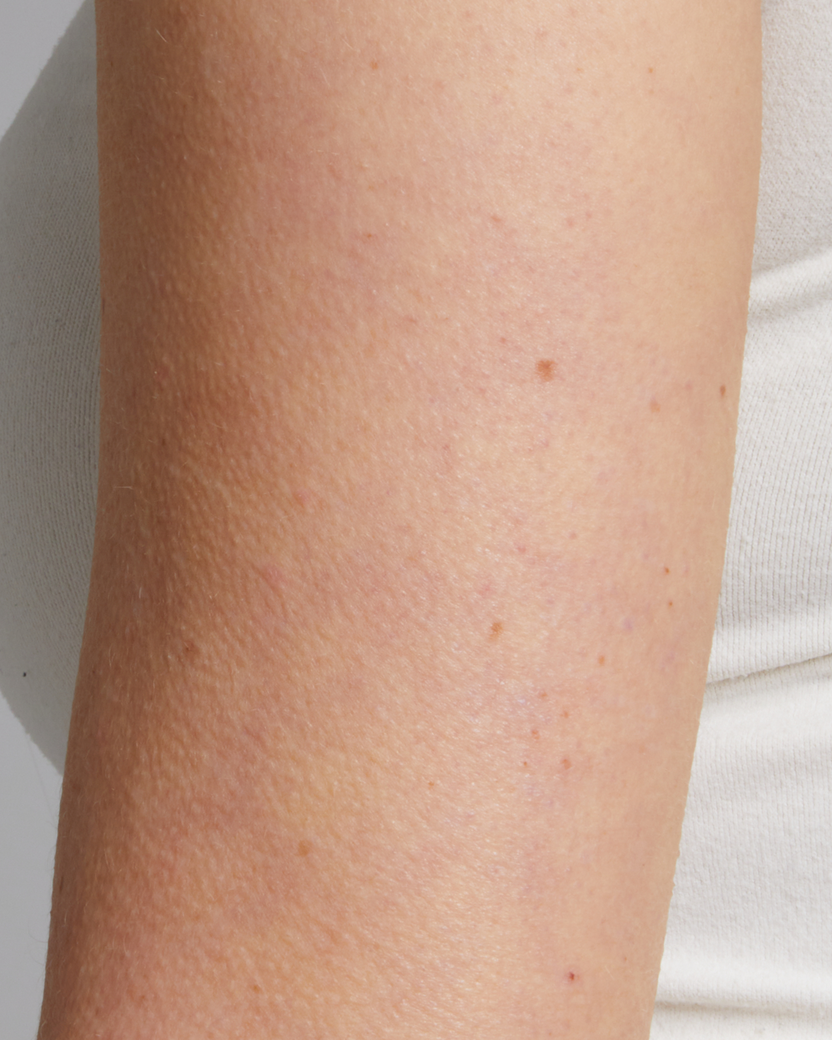 KP + PsO Smoothing Body Treatment | Skinfix – Skinfix USA