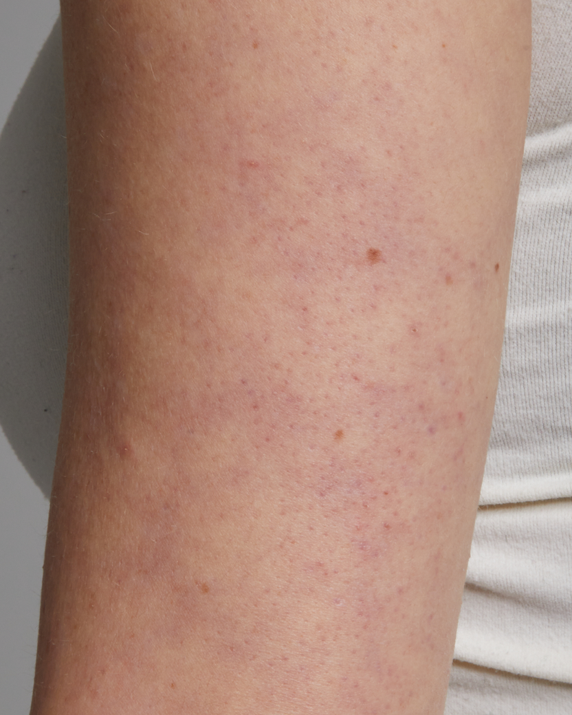 KP + PsO Smoothing Body Treatment | Skinfix – Skinfix USA