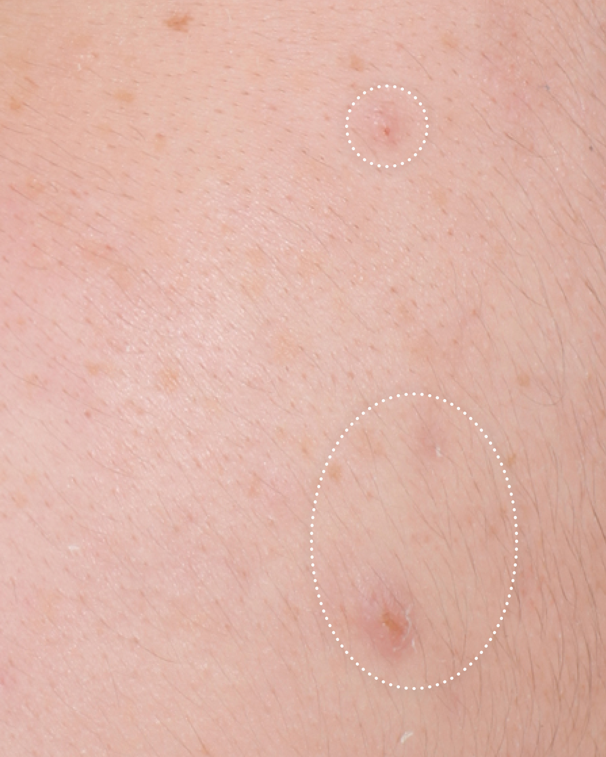 2% BHA Spot Treatment | Skinfix – Skinfix USA