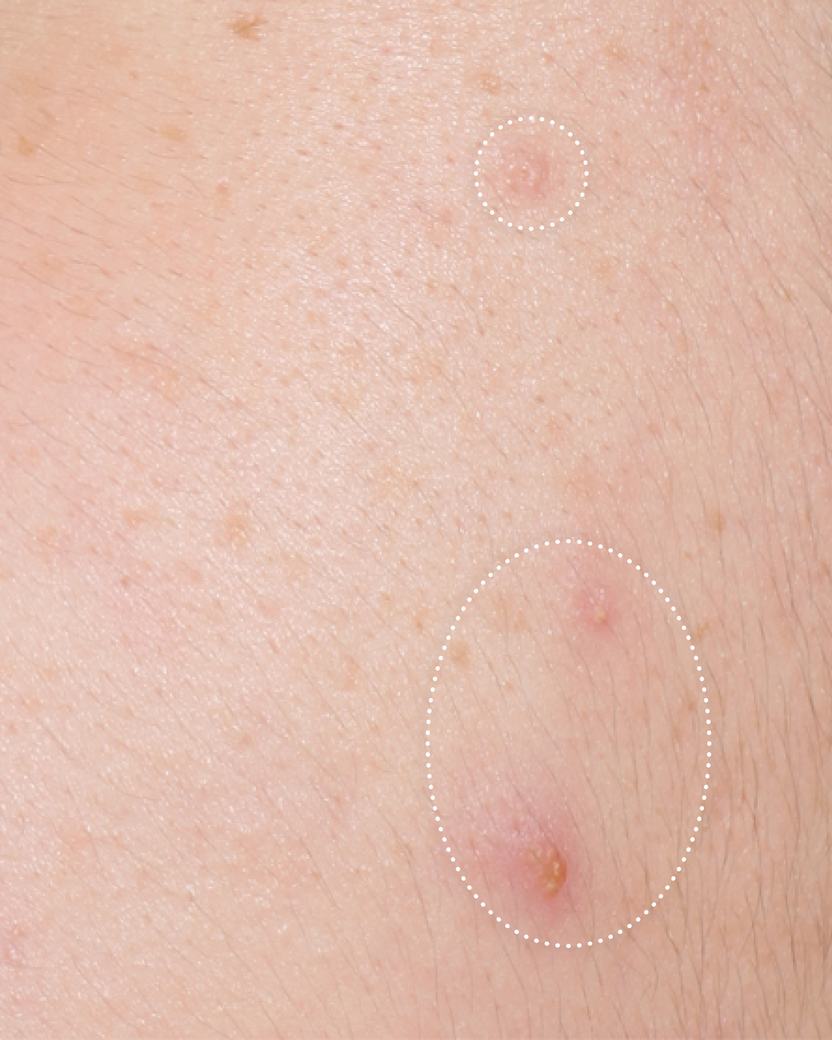 2% BHA Spot Treatment | Skinfix – Skinfix USA